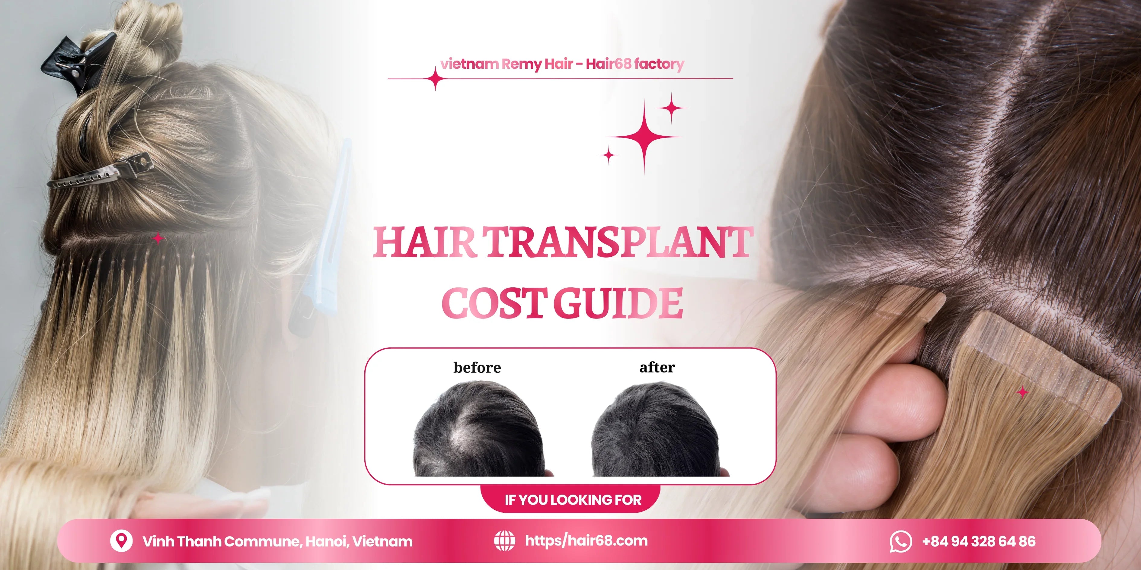 Hair Transplant Cost Guide. The Best Aesthetic and Economic Value ...